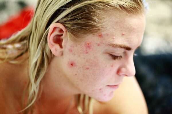 Expert Acne Dermatologist Near Me- Mt. Pleasant